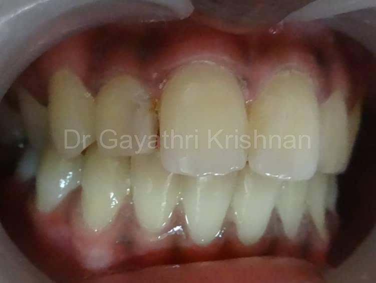 Crowns on front teeth - Dr Gayathri Krishnan
