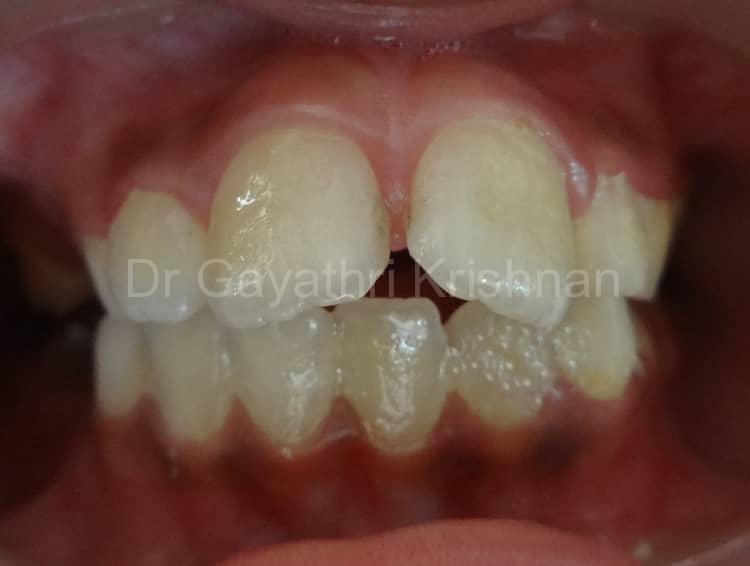 Correction of tongue thrusting habit - Dr Gayathri Krishnan